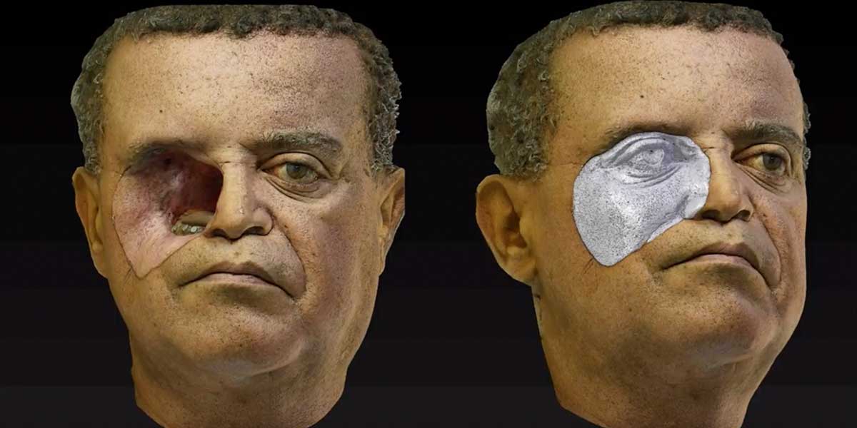 Fotos | Las prótesis faciales en 3D que podrían cambiarles la vida a ...