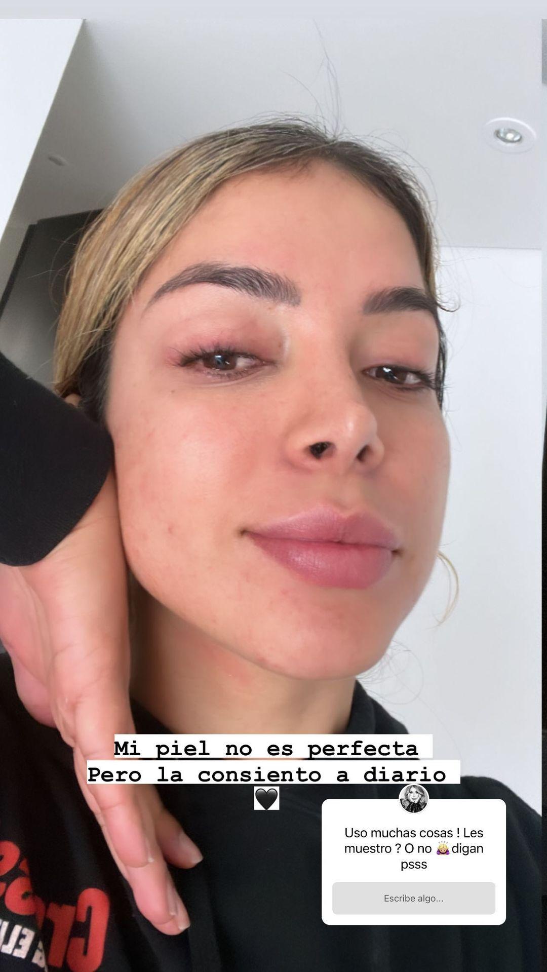 Dahian Muñoz se mostró al natural con su acné en la cara - Canal 1