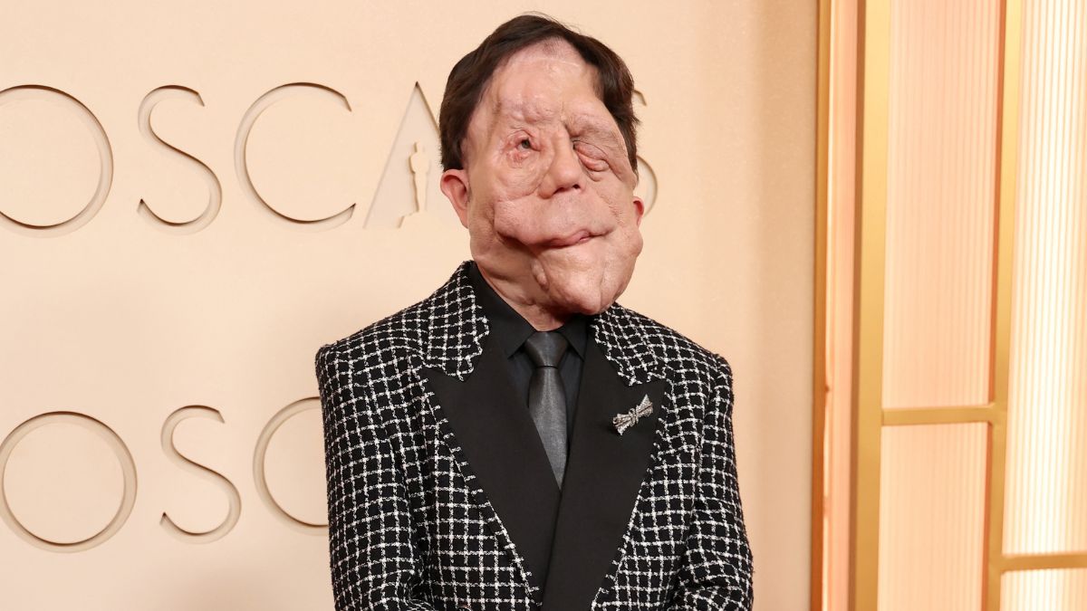 ¿Quién es Adam Pearson y cuál es su enfermedad? - Canal 1